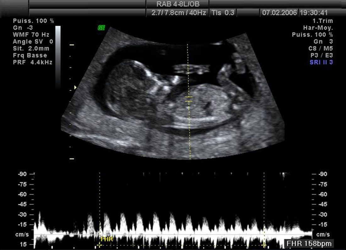 3D a 4D ultrazvuk: Jedinečné stretnutie s bábätkom v brušku - Babyweb.sk